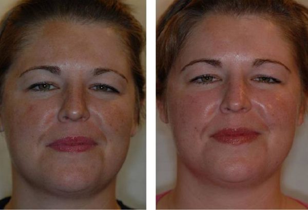Lactic Acid Peel in Phoenix, AZ | Suddenly Slimmer Med Spa