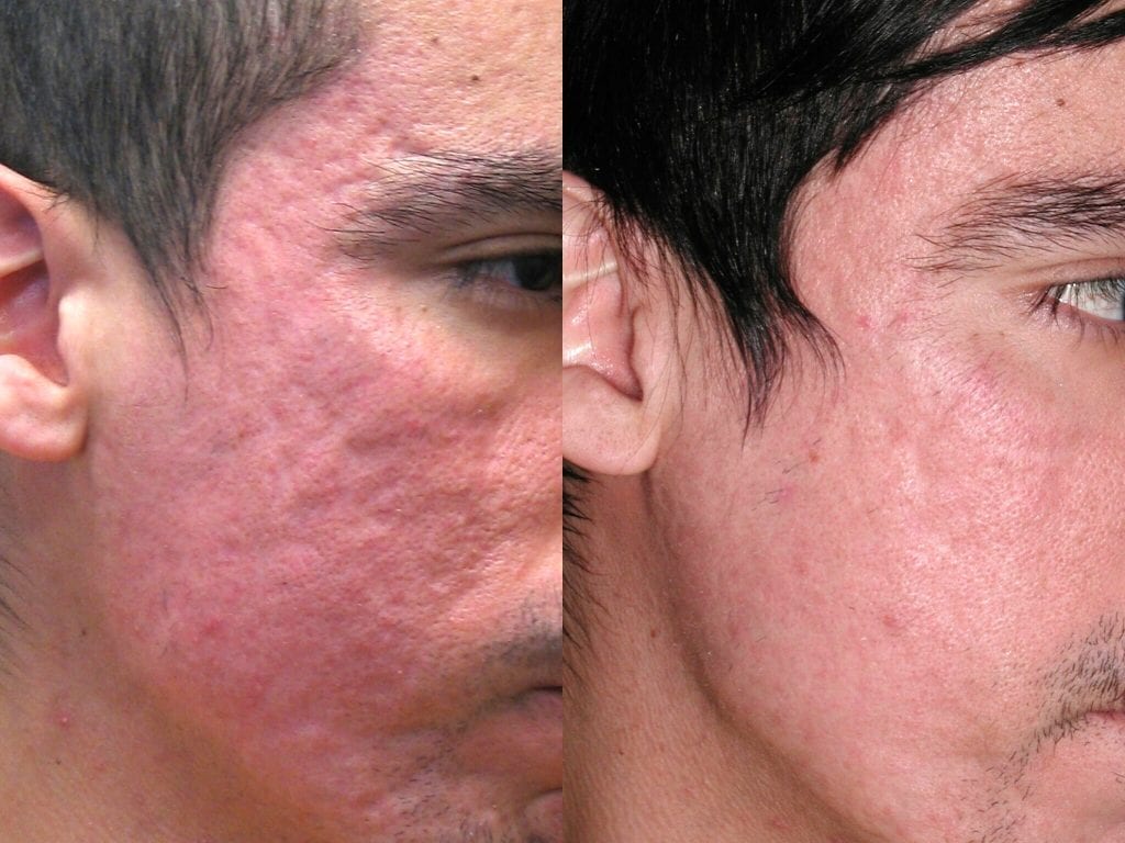 Mild Acne Scars in Phoenix, AZ | Suddenly Slimmer Med Spa