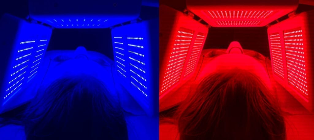 Blue Light and Red Light Acne Treatment