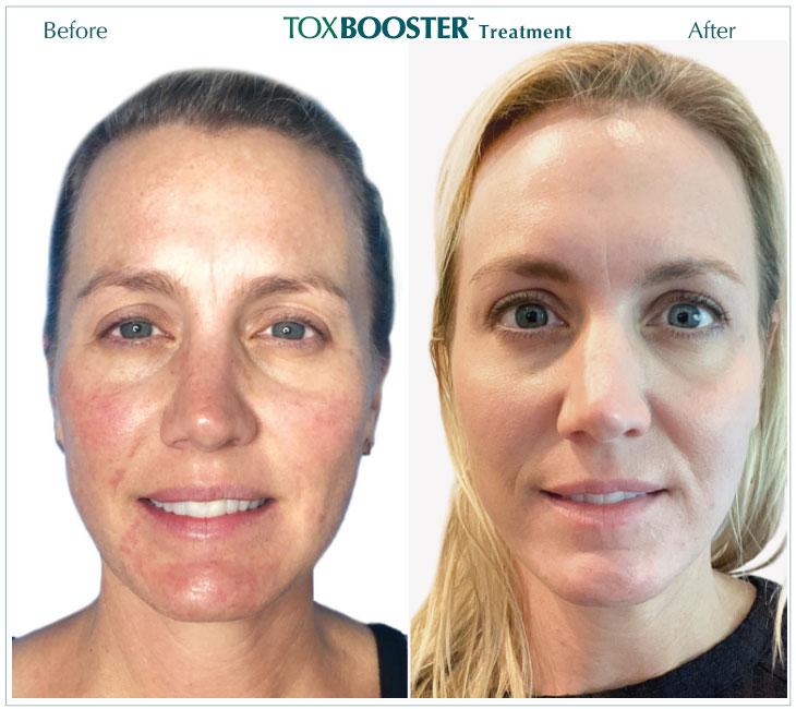 TOXBOOSTER WITH VI PEEL - Suddenly Slimmer Med Spa - Skincare ...