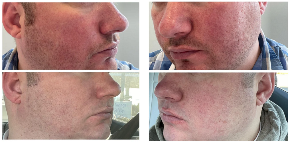 Rosacea Treatments PHX | Rosacea Suddenly Slimmer Med Spa Phoenix