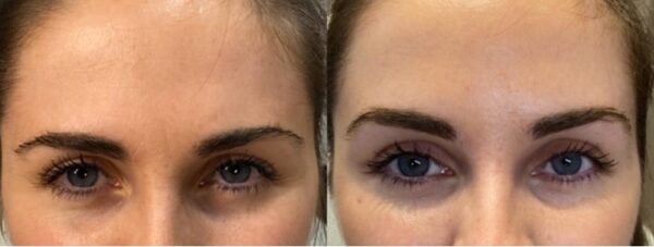 Botox Browlift PHX | Eye Brow Lift Suddenly Slimmer Med Spa Phoenix