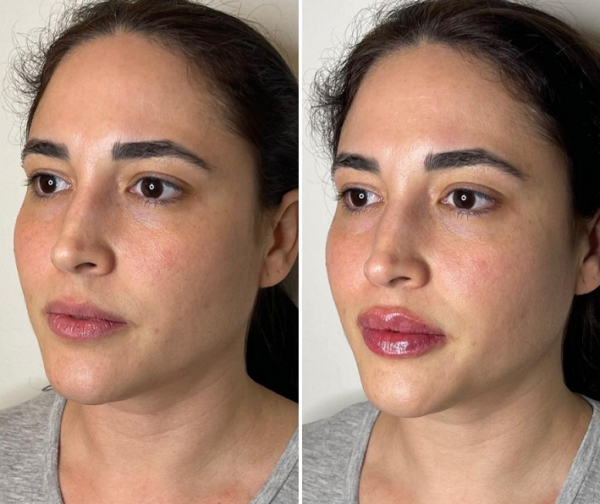 Kysse Lip Filler Phoenix | Kysse Lip Suddenly Slimmer Med Spa PHX