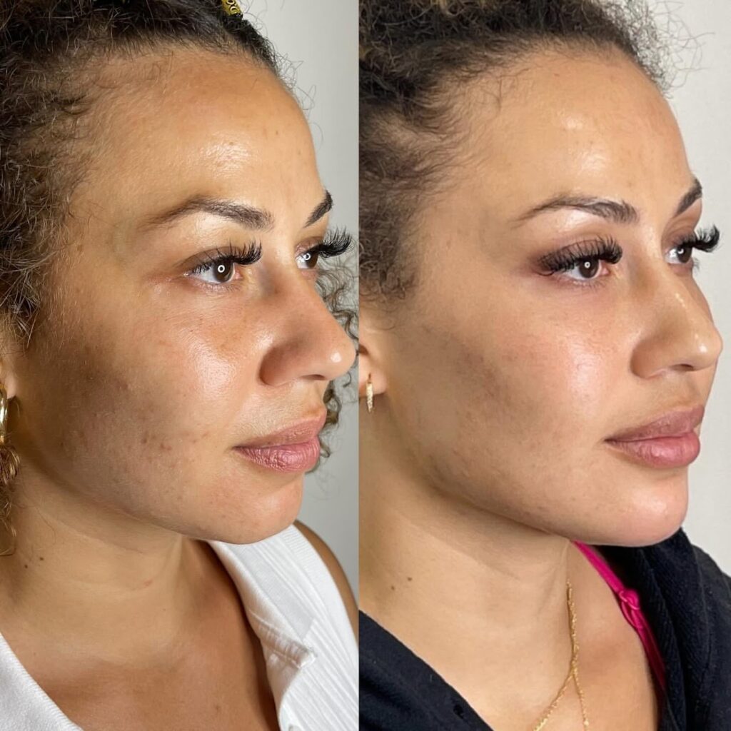 Achieve a Sculpted Jawline with Filler in Phoenix